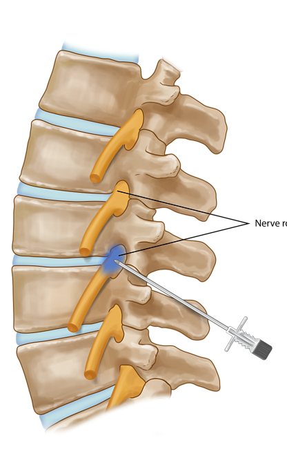 경추간공 경막외 스테로이드 주사(TransForaminal Epidural Steroid Injection, TFESI ...