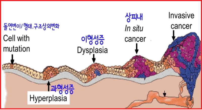 자궁경부이형성증 D06 및 N872 암진단비 보상 받기 Cin3 제자리암 확인 하세요 네이버 블로그