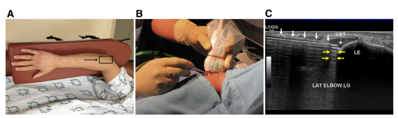 [정형외과 전문의] 골프 팔꿈치 손상 (medial & lateral epicondylitis injection~surgical ...