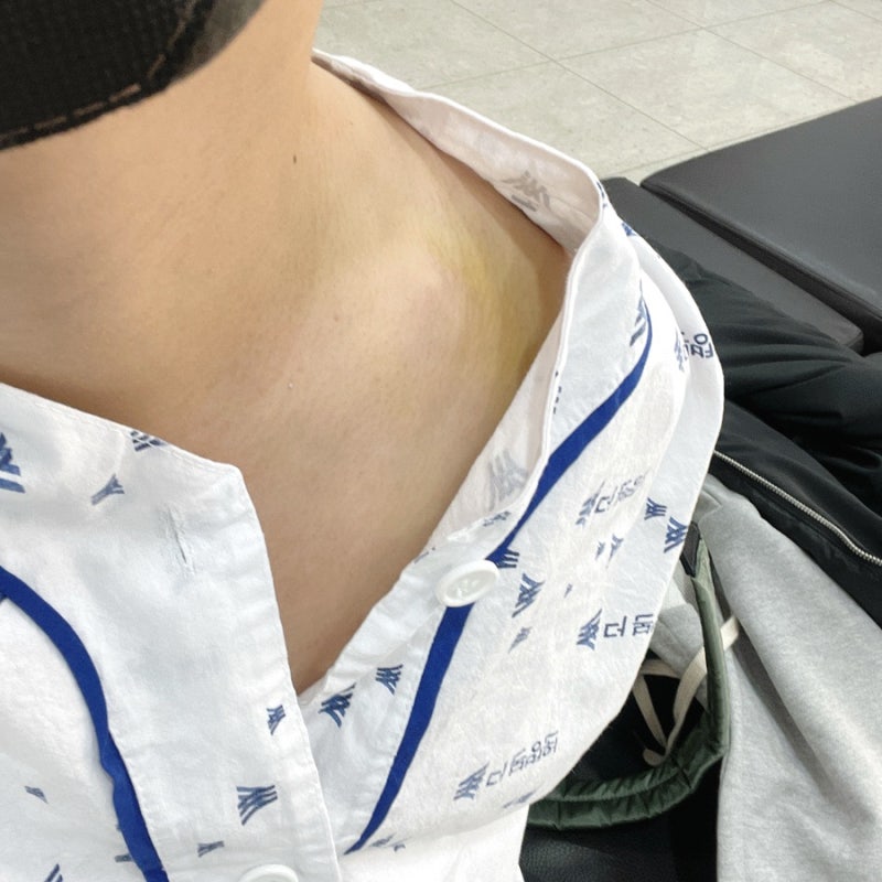쇄골 골절 수술 후기 시간 비용까지 네이버 블로그