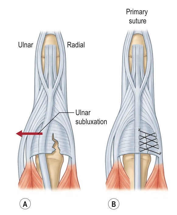 [시상대 파열] 시상대 파열은 어떻게 치료하나요. (feat. 딱밤 치기 중 다쳤어요.) : 네이버 블로그