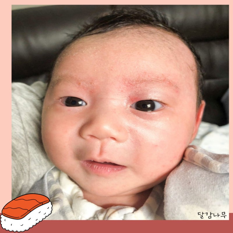 신생아 연어반 원인 없어지는 시기 아기 얼굴에 붉은 반점 빨간점 네이버 블로그