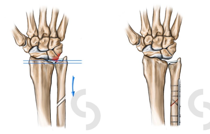 5년 이상 지속된 손목 바깥쪽 통증. 척골 충돌 증후군의 치료 (ulnar impaction syndrome) : 네이버 블로그