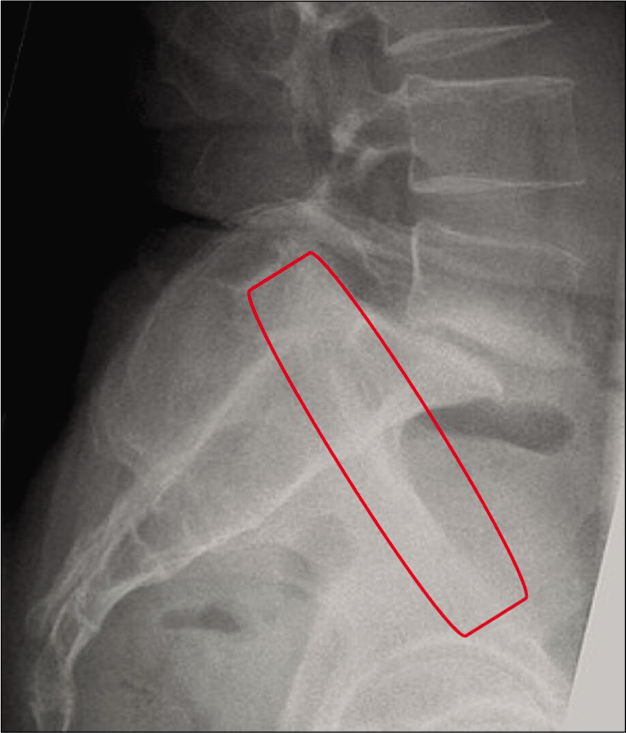 천추 1번 경추간공 경막외 스테로이드 주사(S1 TransForaminal Epidural Steroid Injection ...