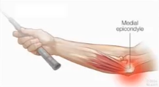 [정형외과 전문의] 골프 팔꿈치 손상 (medial & lateral epicondylitis injection~surgical ...