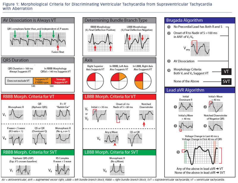 Wide QRS complex tachycardia 감별 기초 : 네이버 블로그