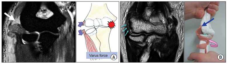 [정형외과 전문의] 팔꿈치 관절의 불안정성, 탈구 (elbow dislocation, PLRI, PMRI, fracture ...