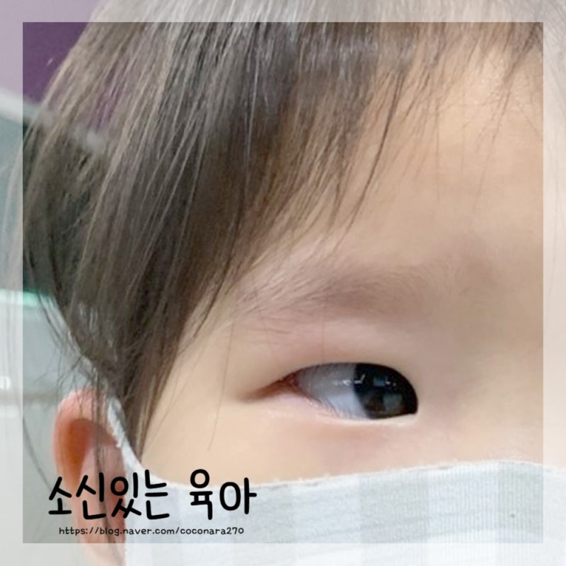 아기 눈밑부음 눈충혈 한쪽 눈붓기 알레르기 결막염 네이버 블로그