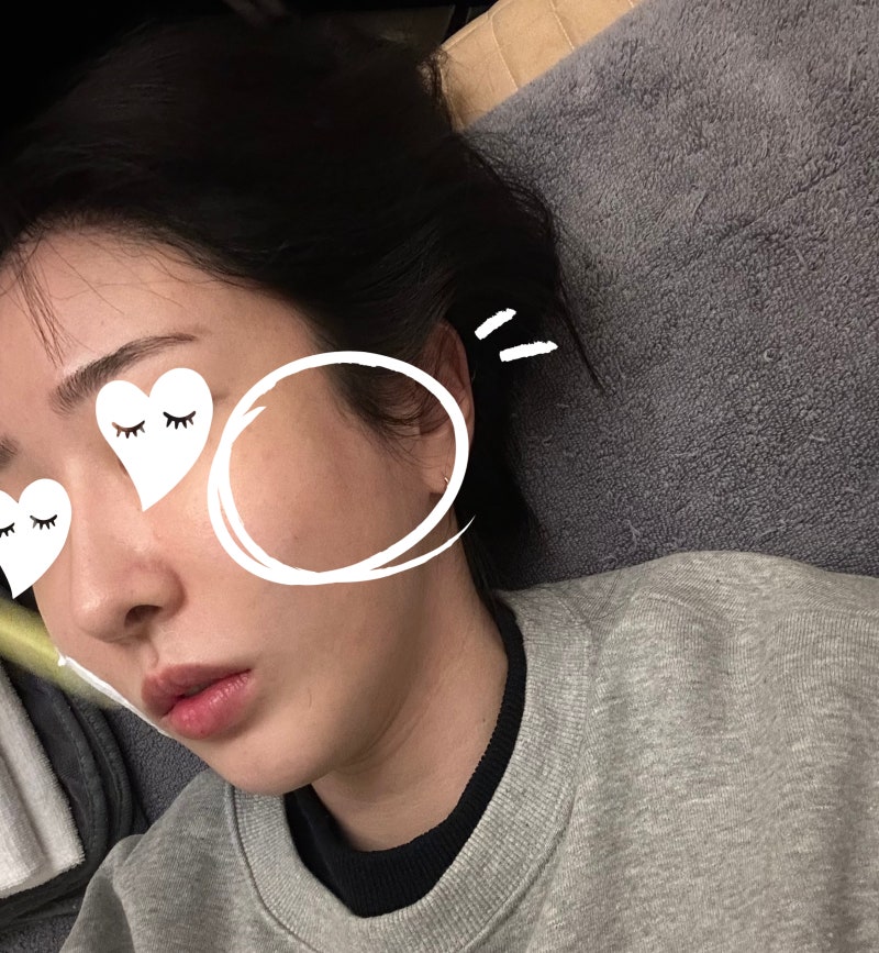 땅콩형 얼굴 옆볼 꺼짐 패임 해결 콜라겐부스터 코어 재시술 후기(필러, 스컬트라 아님) : 네이버 블로그