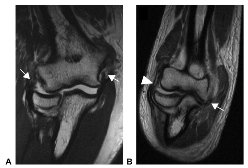 [정형외과 전문의] 팔꿈치 관절의 불안정성, 탈구 (elbow dislocation, PLRI, PMRI, fracture ...