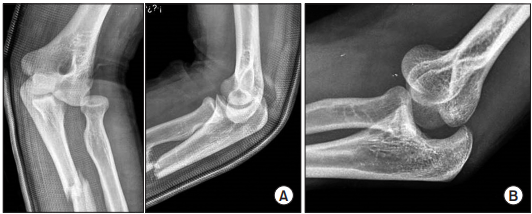 [정형외과 전문의] 팔꿈치 관절의 불안정성, 탈구 (elbow dislocation, PLRI, PMRI, fracture ...