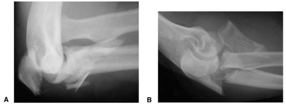 [정형외과 전문의] 팔꿈치 관절의 불안정성, 탈구 (elbow dislocation, PLRI, PMRI, fracture ...