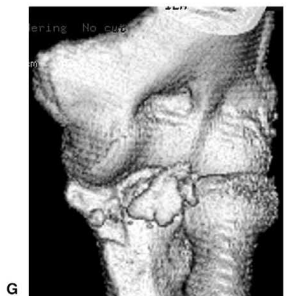[정형외과 전문의] 팔꿈치 관절의 불안정성, 탈구 (elbow dislocation, PLRI, PMRI, fracture ...