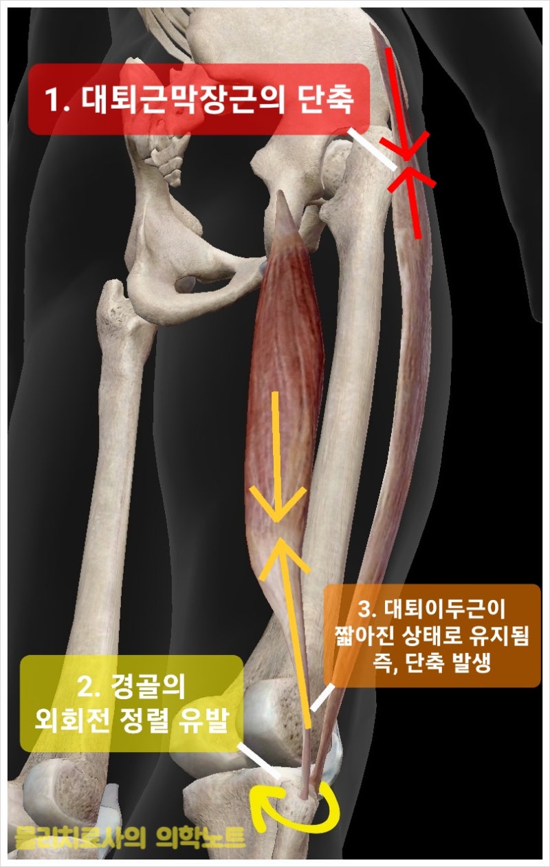 고관절 통증 원인 햄스트링hamstring 대퇴이두근 단축shortness Of Biceps Femoris 무릎