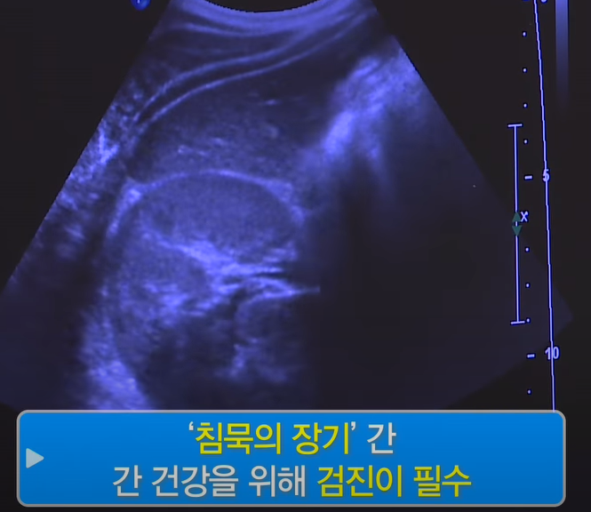 간이 나빠지는 초기 증상 간염 간경화 간암자연치유식이 21 네이버 블로그
