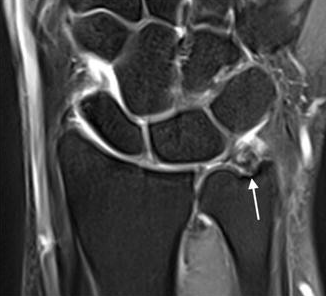 TFCC 통증 수술이 가장 빠른 답일까요? TFCC 한의원 / 손목통증 한의원 : 네이버 블로그
