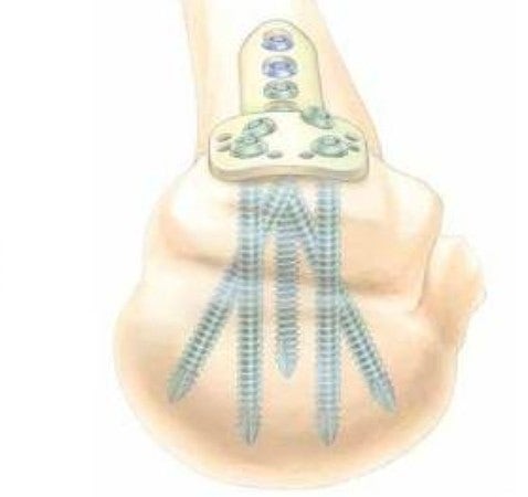 plate 종류2 - 정형외과 스크럽 -LCP plate : 네이버 블로그