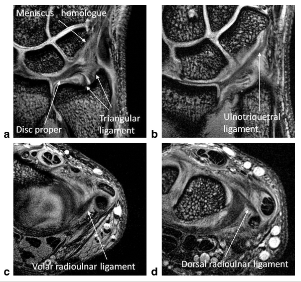 TFCC 통증 수술이 가장 빠른 답일까요? TFCC 한의원 / 손목통증 한의원 : 네이버 블로그