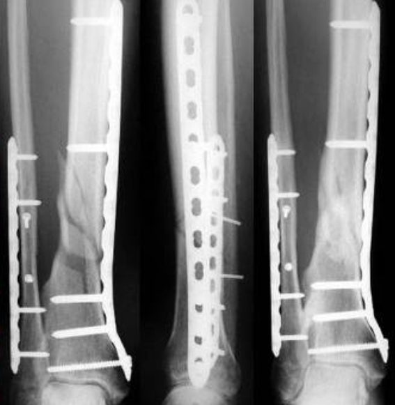 plate 종류2 - 정형외과 스크럽 -LCP plate : 네이버 블로그