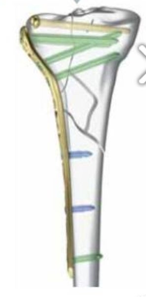 plate 종류2 - 정형외과 스크럽 -LCP plate : 네이버 블로그