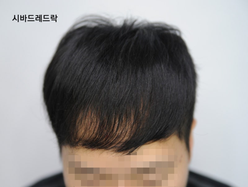 남자앞머리헤어증모술m자탈모남자앞머리숱붙임머리 네이버 블로그