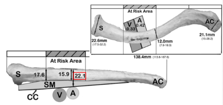 [정형외과 전문의] 쇄골 골절의 치료 (Fracture of clavicle shaft, proximal clavicle ...