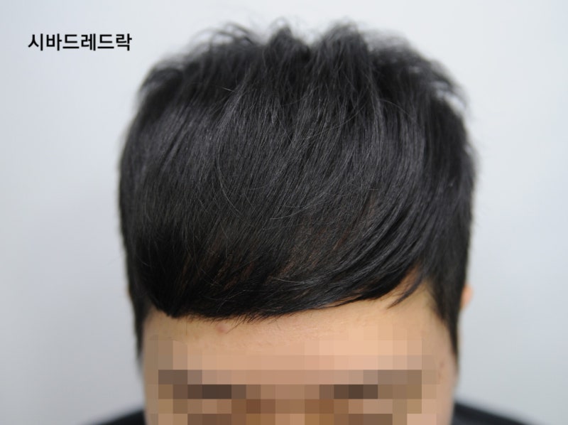 남자앞머리헤어증모술m자탈모남자앞머리숱붙임머리 네이버 블로그