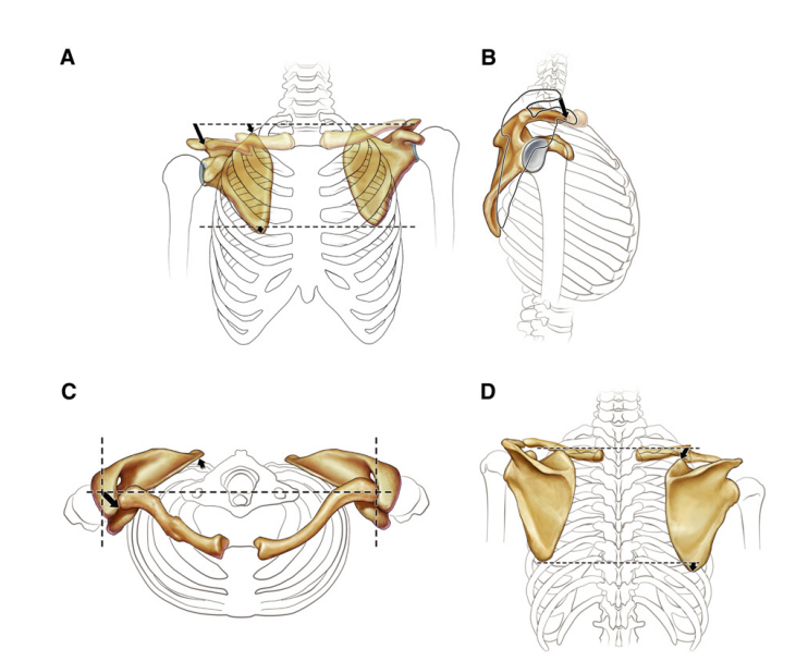 [정형외과 전문의] 쇄골 골절의 치료 (Fracture of clavicle shaft, proximal clavicle ...