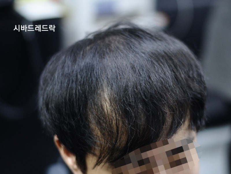 남자앞머리헤어증모술m자탈모남자앞머리숱붙임머리 네이버 블로그