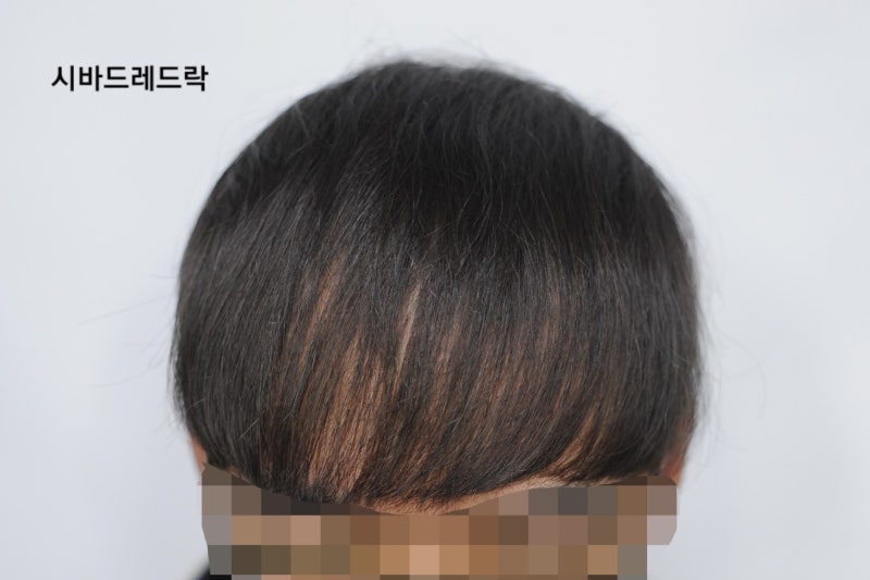 남자앞머리헤어증모술m자탈모남자앞머리숱붙임머리 네이버 블로그