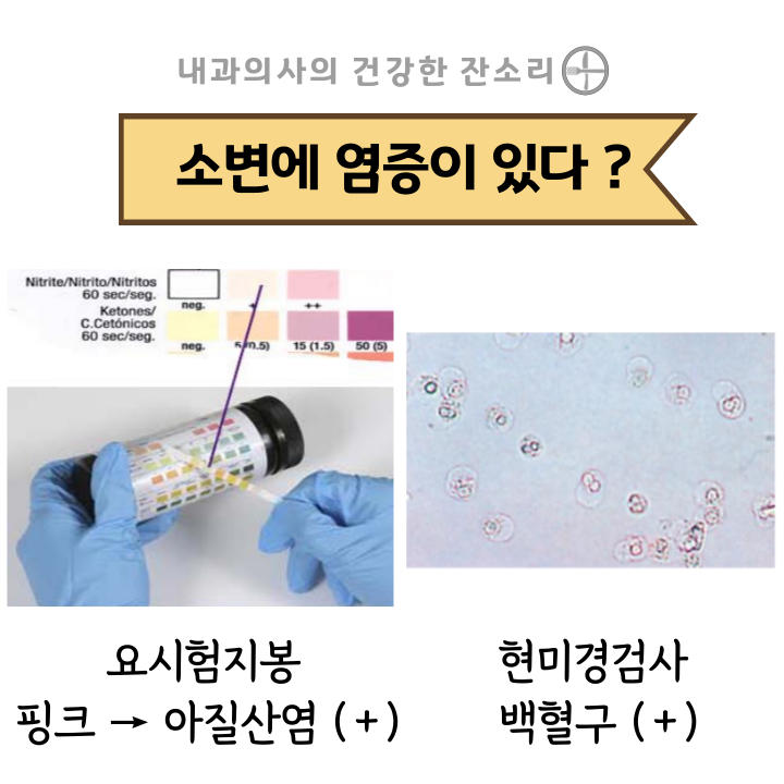소변 염증 백혈구 있다 증상도 없는데 치료를 받아야 하나요 무증상 세균뇨 네이버 블로그