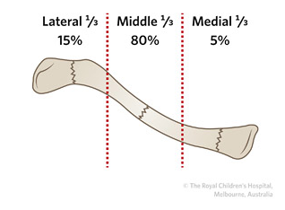 [정형외과 전문의] 쇄골 골절의 치료 (Fracture of clavicle shaft, proximal clavicle ...
