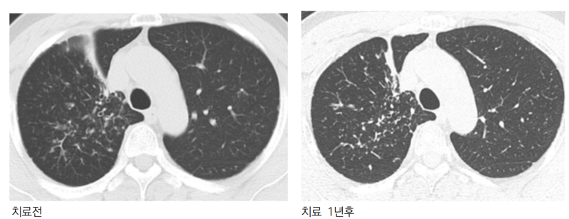 활동성 폐결핵 흉부 X선 사진 증례 석회화 결절 폐결절 네이버 블로그