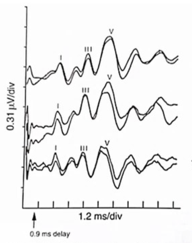 청성뇌간반응auditory Brainstem Responses Abr 네이버 블로그