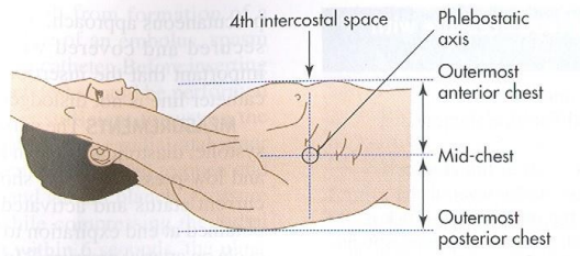 A-line(동맥관) monitoring, Arterial blood pressure wave 기본지식 : 네이버 블로그
