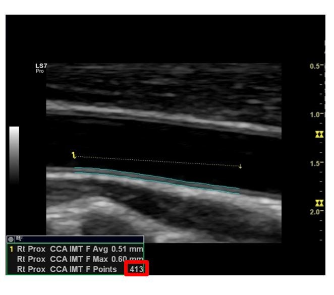 GE Fortis (E10 슬림버전), 초음파 최상위 기종 : 네이버 블로그