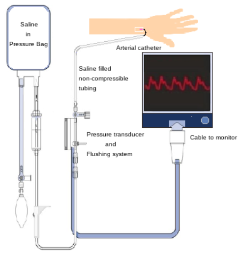 A-line(동맥관) monitoring, Arterial blood pressure wave 기본지식 : 네이버 블로그