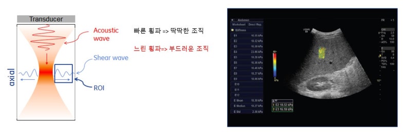 GE Fortis (E10 슬림버전), 초음파 최상위 기종 : 네이버 블로그