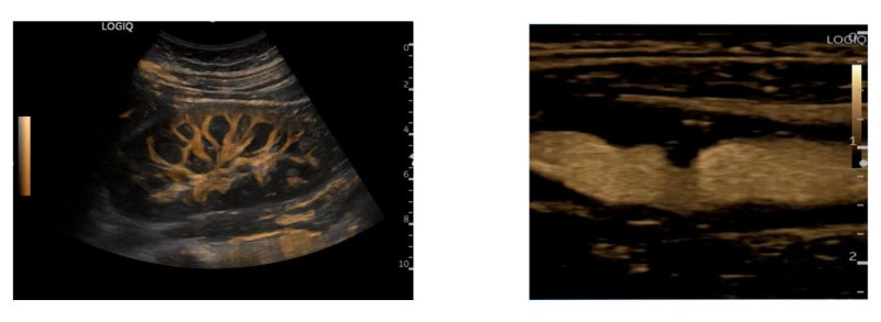 GE Fortis (E10 슬림버전), 초음파 최상위 기종 : 네이버 블로그