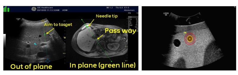 GE Fortis (E10 슬림버전), 초음파 최상위 기종 : 네이버 블로그