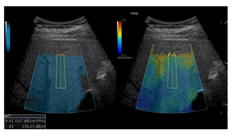 GE Fortis (E10 슬림버전), 초음파 최상위 기종 : 네이버 블로그