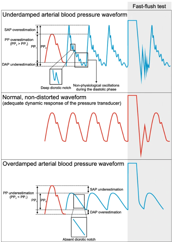 A-line(동맥관) monitoring, Arterial blood pressure wave 기본지식 : 네이버 블로그