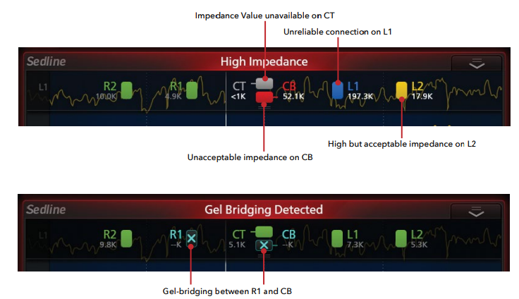 마취 심도 모니터링 : Sedline(Masimo)에 관하여(SEF, suppression ratio, DSA, EMG ...