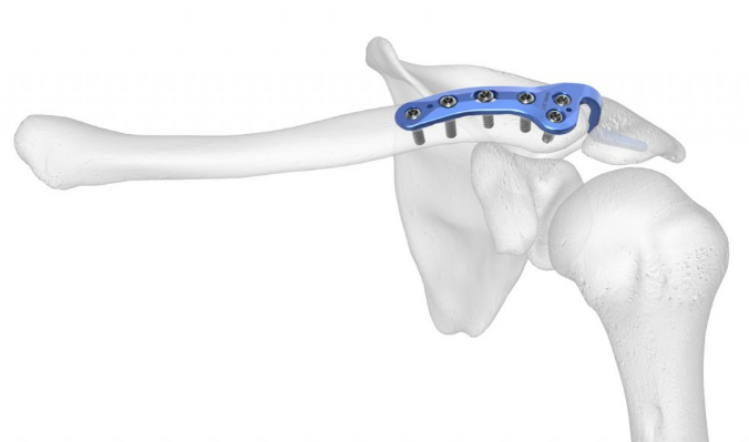 [정형외과 전문의] 쇄골 골절의 치료 (Fracture of clavicle shaft, proximal clavicle ...