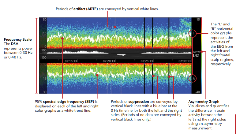 마취 심도 모니터링 : Sedline(Masimo)에 관하여(SEF, suppression ratio, DSA, EMG ...