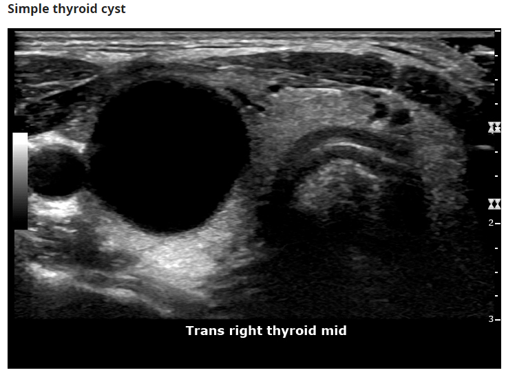 갑상선 낭종(갑상선 물혹, thyroid cyst), 갑상선 낭성결절(thyroid cystic nodule) : 네이버 블로그