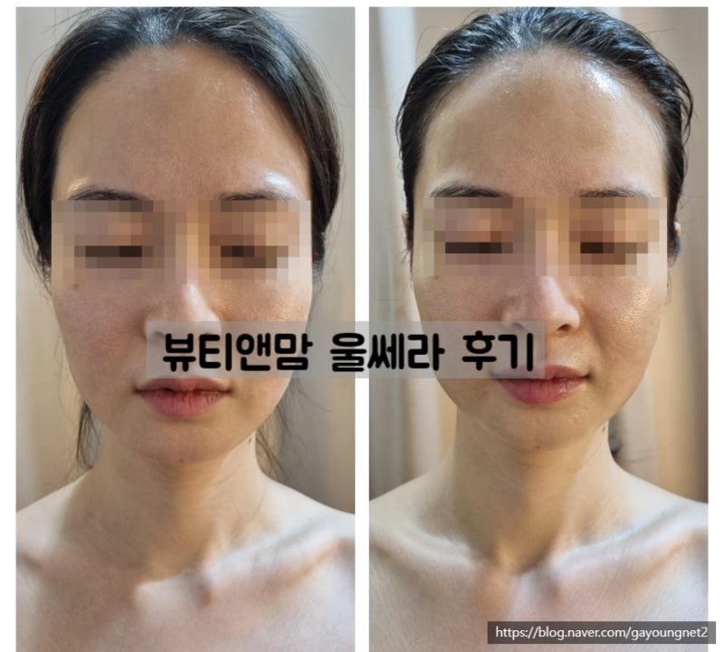 포항웨딩관리 문덕피부관리 울쎄라 브이라인 리프팅 네이버 블로그