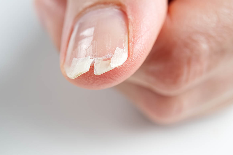 손톱영양제 뉴트원 비오틴부스터 특징 및 장점 【비오틴 비오틴효과 머리카락빠짐 탈모에좋은음식】 네이버 블로그