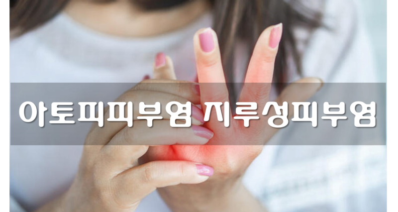 노바손 노바손크림 스테로이드 항생제 연고 알레르기성 피부질환 습진 접촉성피부염 건선 1도 화상 약국약 효능 효과 복용법 부작용