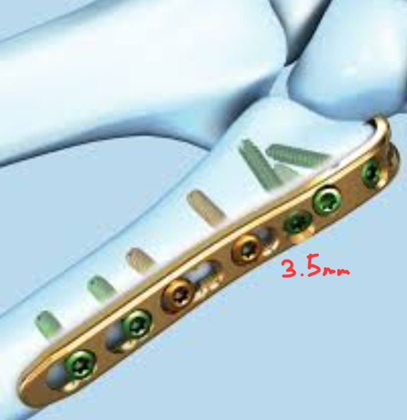 수술실 정형외과 스크럽- Wrist ORIF 보강 plate -hand ORIF : 네이버 블로그